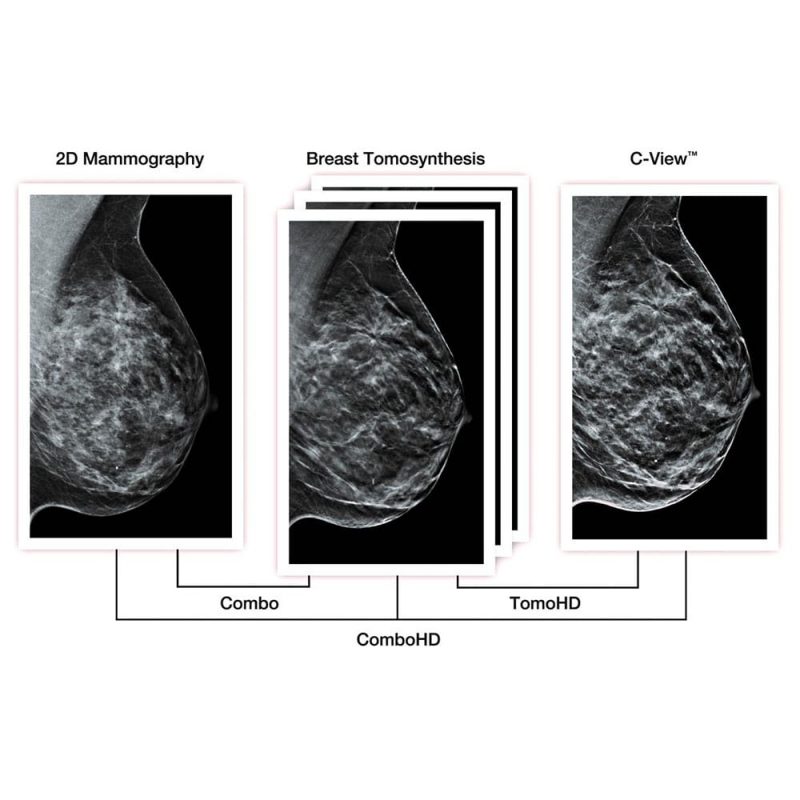 HOLOGIC – Imagen Sintetizada C-View | Suministros Radiográficos